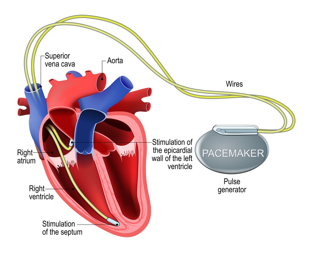 Pacemaker Placement Pacemaker Placement