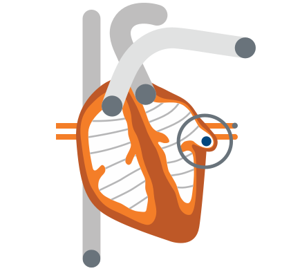 The Watchman Device: In Patients with AFib, an Alternative to Blood ...