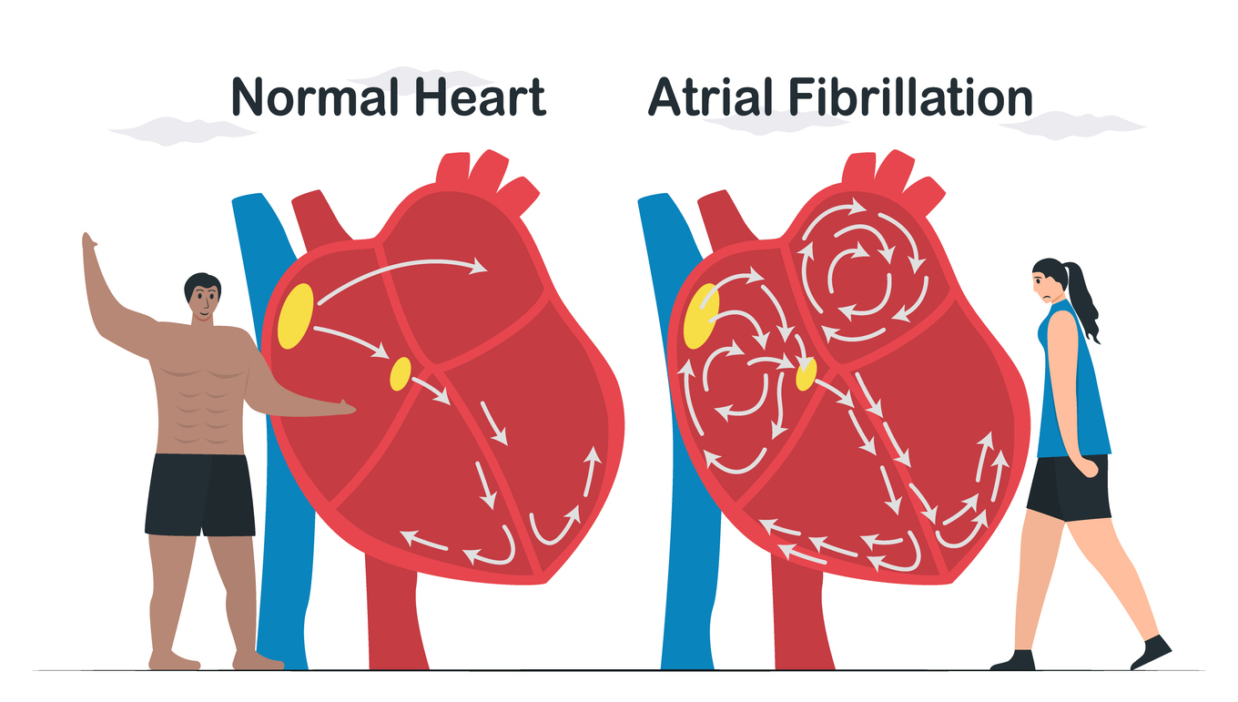 The Watchman Device: In Patients with AFib, an Alternative to Blood ...