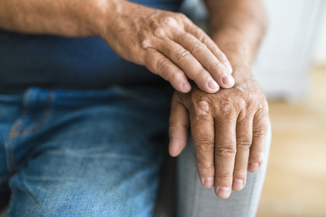 Psoriatic Arthritis: All You Need to Know - WWMG Blog