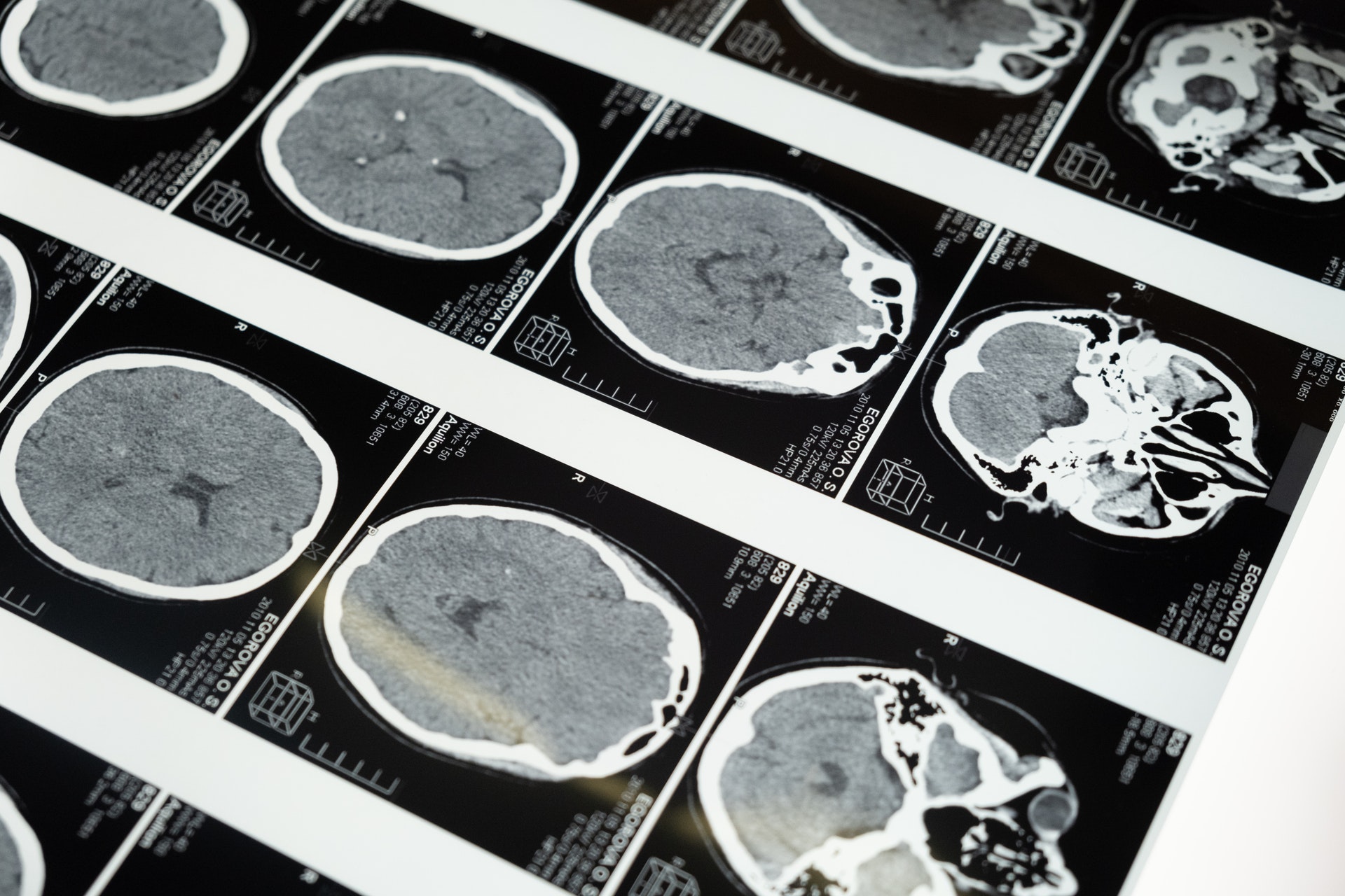 What Does an MRI Test Reveal?